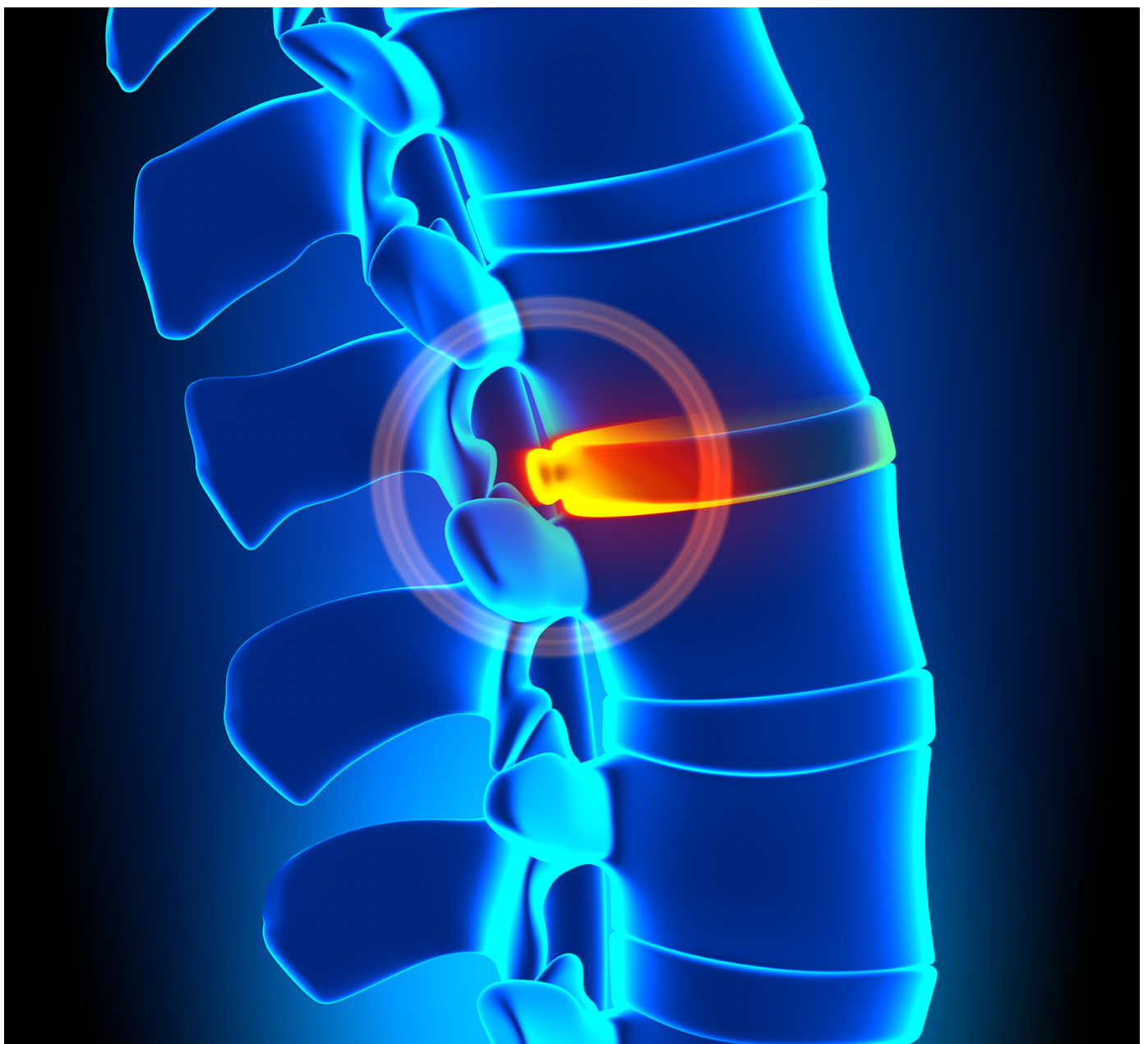 Bulging and Herniated Discs are Common - Zang Physical Therapy